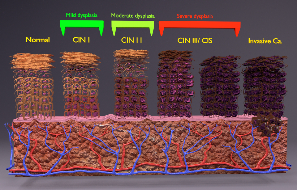 Cervical cancer dysplasia CIN