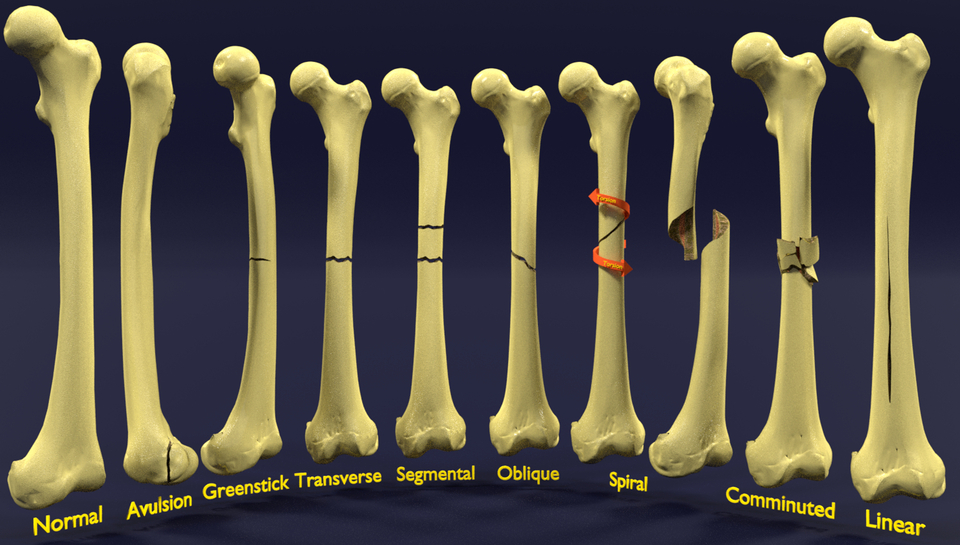 Fracture types labelled 3D Model