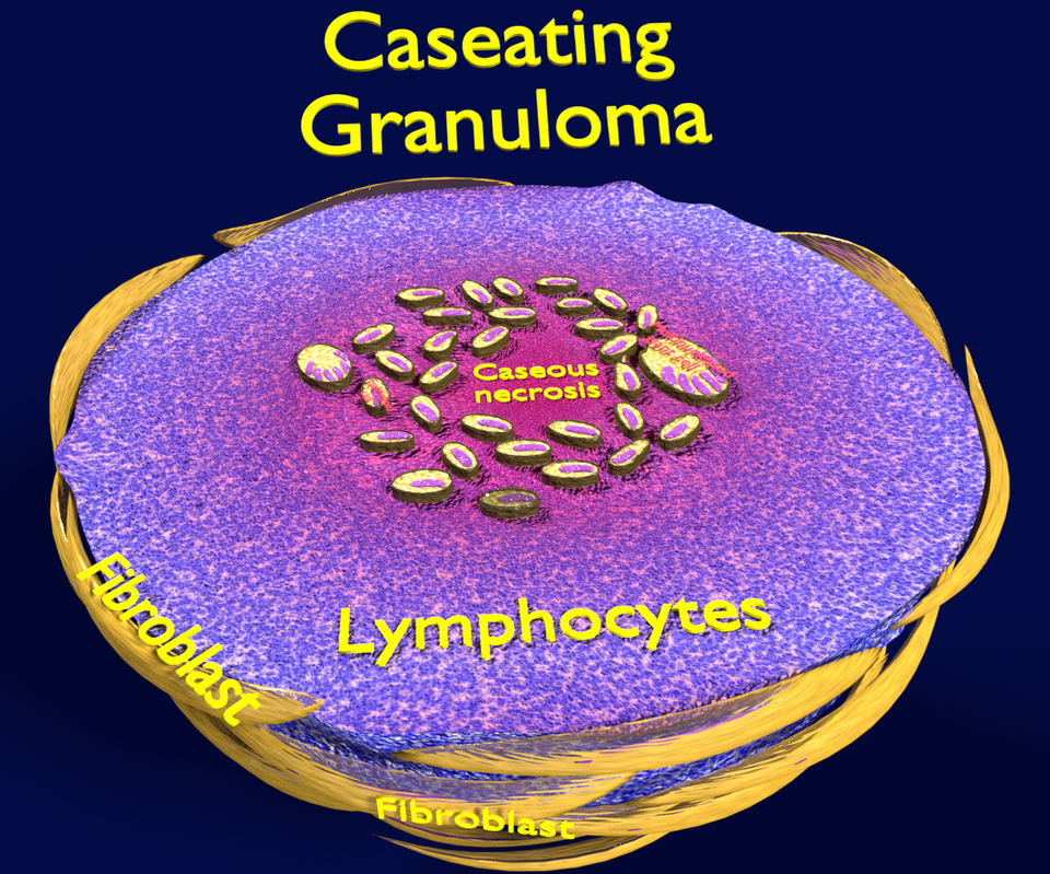 Caseating granuolma tuberculosis labelled