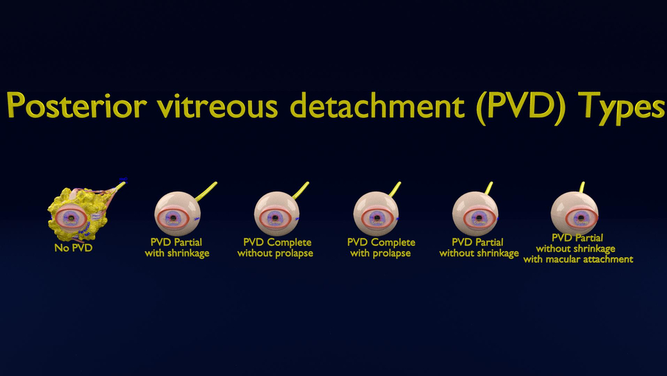 Posterior vitreous detachment types eye