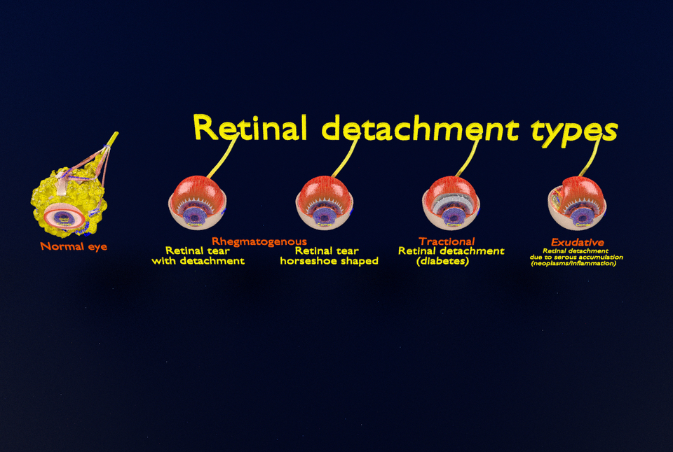 Retinal detachment types eye
