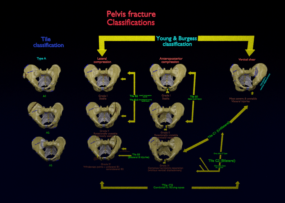 Pelvis fractures 3D Model