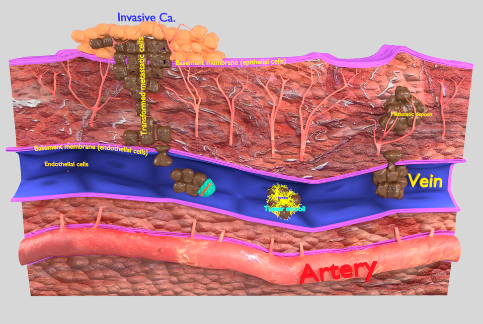 cancer metastasis spread low poly