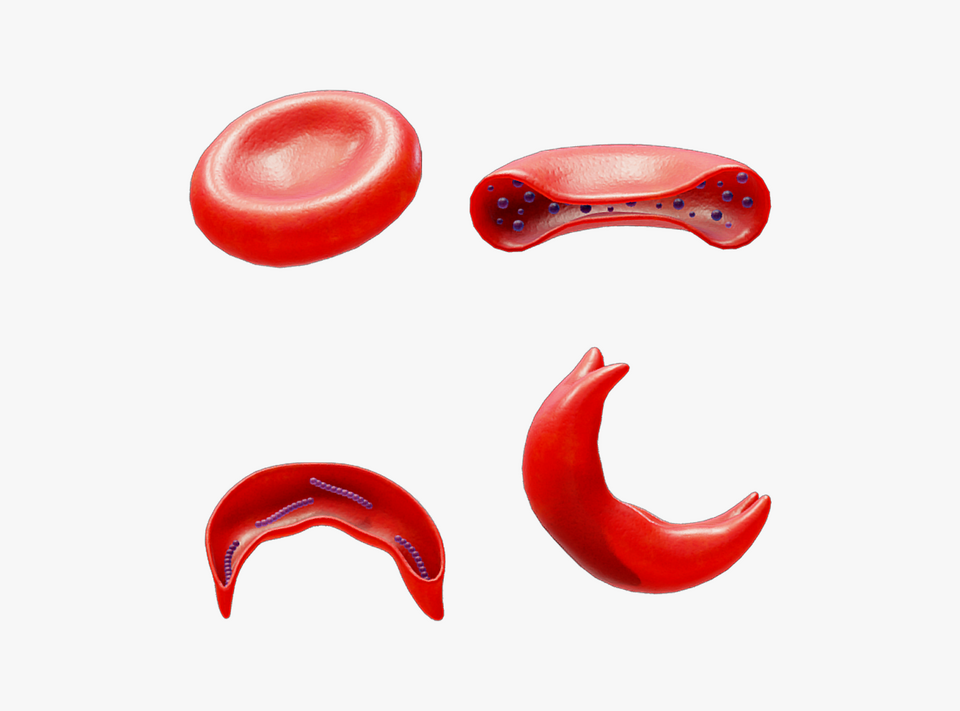 Cross Section of Normal vs Sickle Red Blood Cell