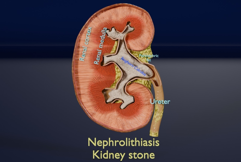 Kidney stone nephrolithiasis Staghorn calculus