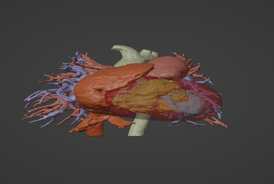 3D Model of Human Heart with Patent Ductus Arteriosus (PDA) - generated ...