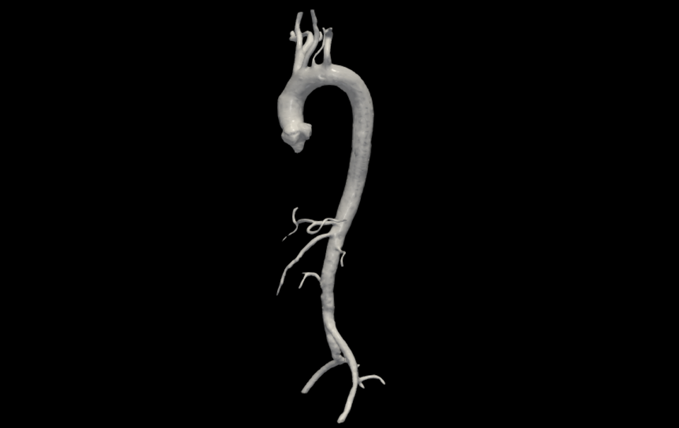 3D Model of Aorta and Aortic Vessel Tree - generated from real patient