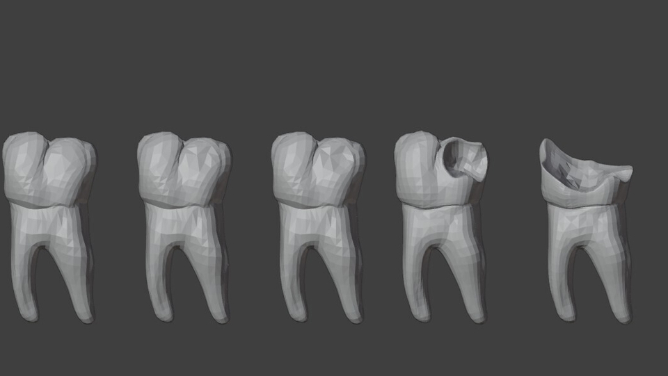 3D Model of Tooth Decay Progression - Dental Model