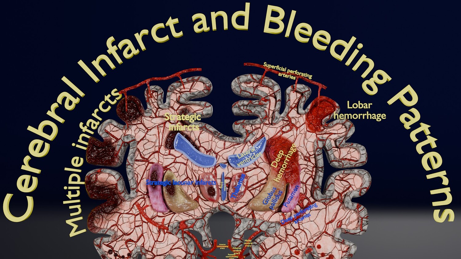 Stroke brain infarct hemorrhage types
